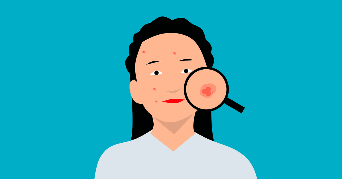 Acnee în diverse locuri pe corp? Uite ce boli semnalează!