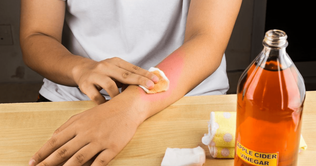 Metode blânde cu care pot fi îndepărtaţi negii