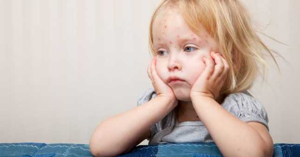 Varicela: simptome, complicaţii, mod de transmitere, tratament şi ...