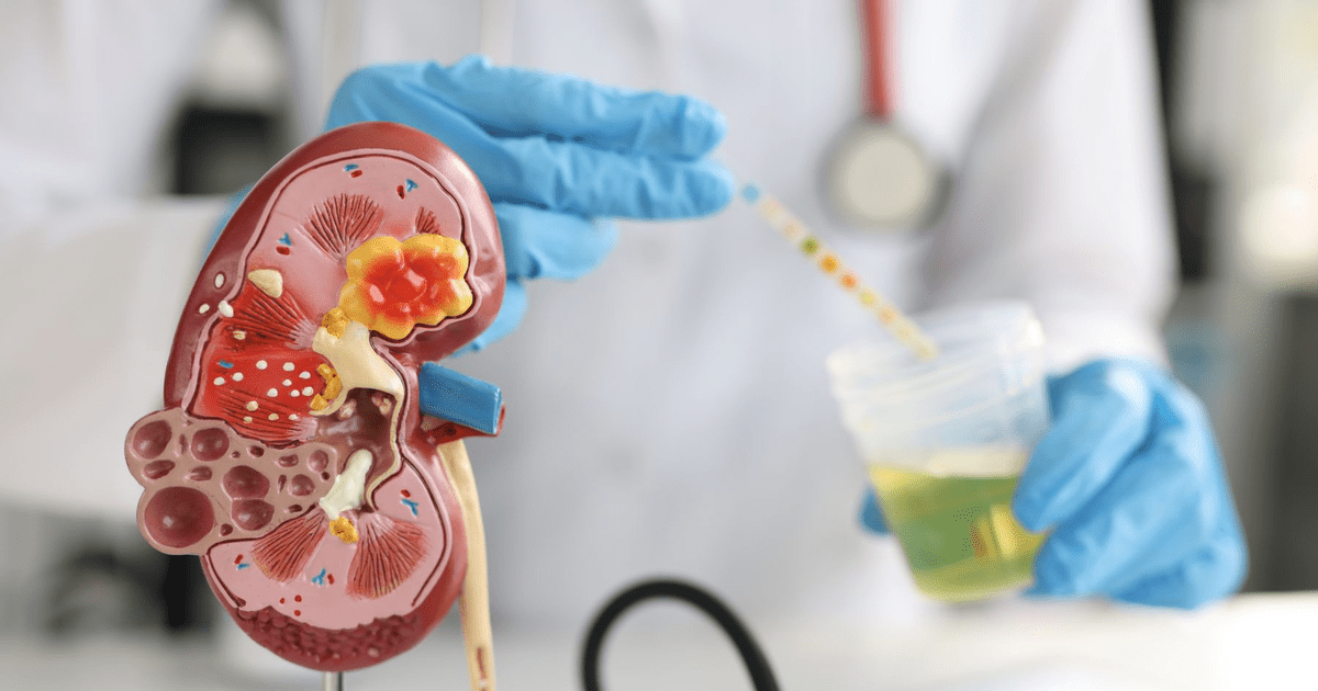 Atenție la aceste alimente, pot să provoace pietre la rinichi!