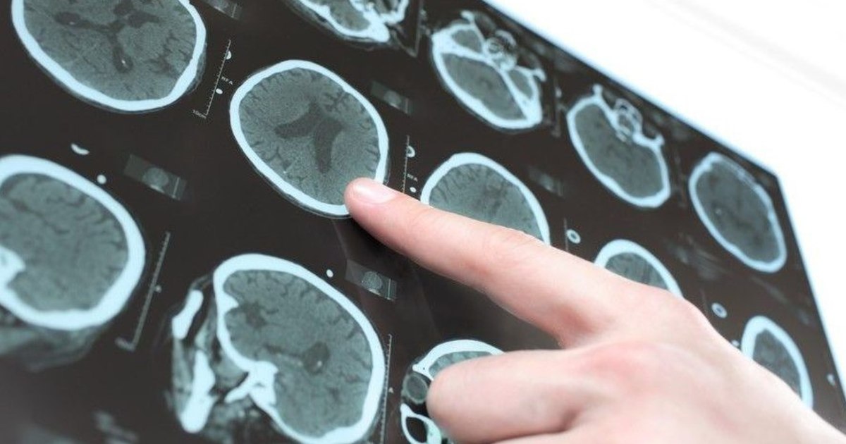 Electrocutarea creierului, tratament pentru depresie și Parkinson. Cum ...