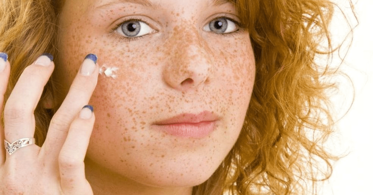 3 secrete care te scăpa de pistrui