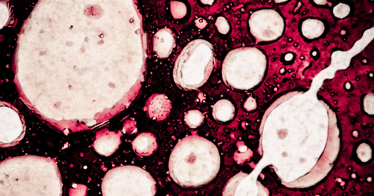 Cum identificăm simptomele cancerului în stadii incipiente