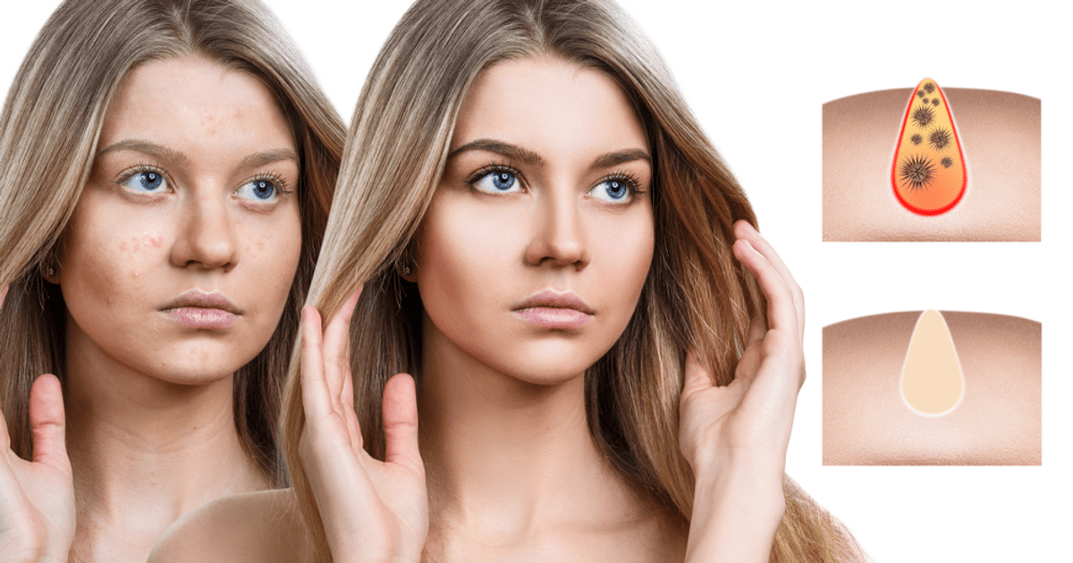 Spune adio punctelor negre, porilor dilataţi şi petelor! Ai la ...