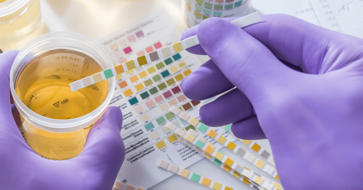 Ce indică o schimbare a aspectului urinei? Culorile intense sunt semne ...