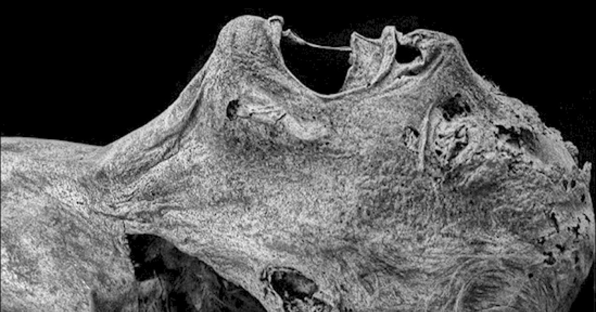 Holera, boala care a ucis în masă în secolul al XIX-lea. Explicaţia ...